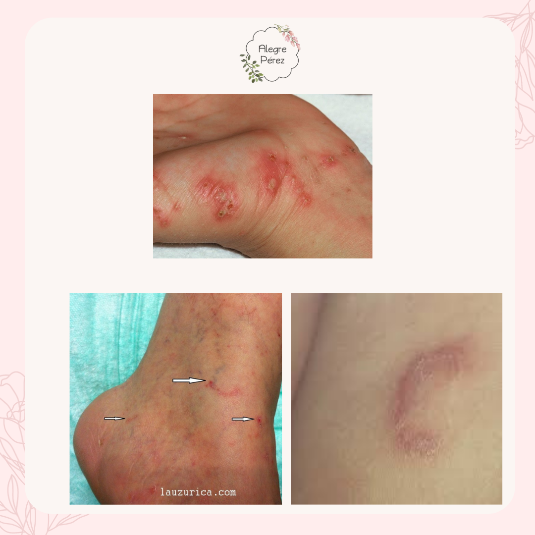 SARNA EN HUMANOS - AP Pharma